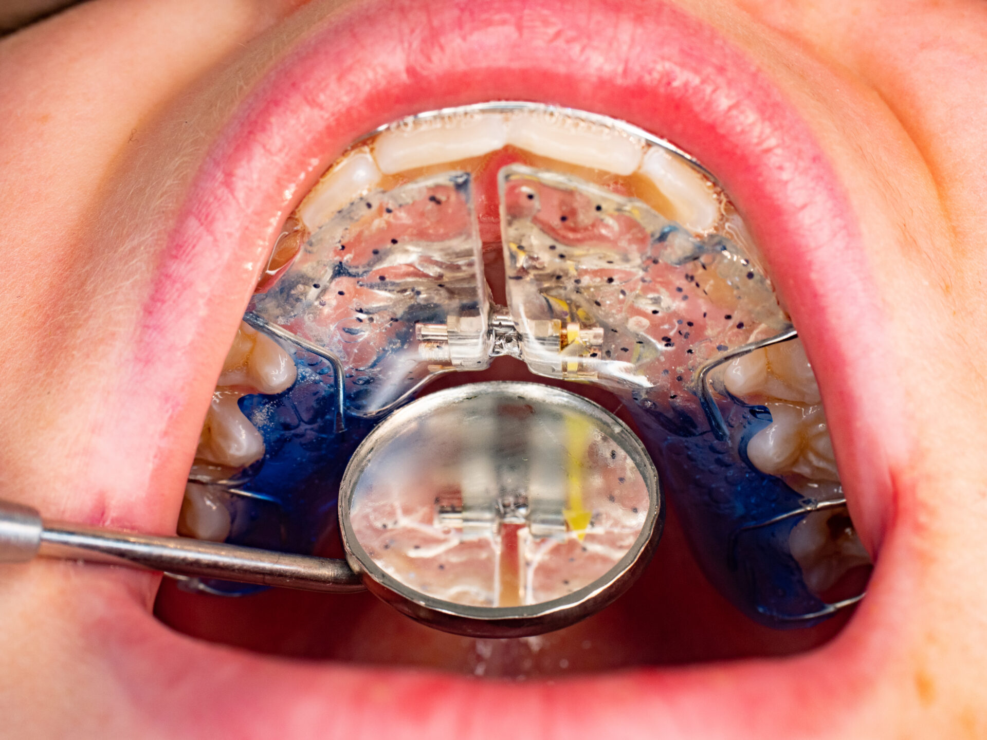 Palatal Expanders in Treasure Valley | Orthodontic Appliance